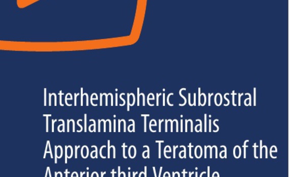 Interhemispheric Subrostral Translamina Terminalis Approach to a ...