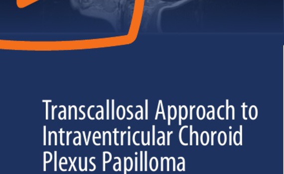 Transcallosal Approach to an Intraventricular Choroid Plexus Papilloma ...