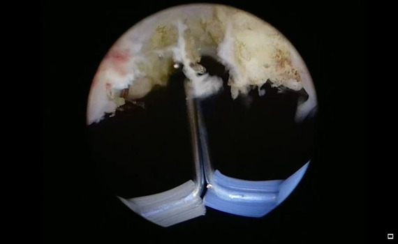 Bladder Neck Incision - Alexander Street, a ProQuest Company
