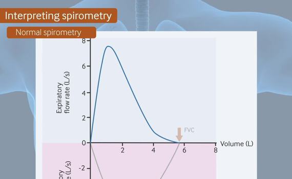 Spirometry technique and interpretation - Alexander Street, a ProQuest ...
