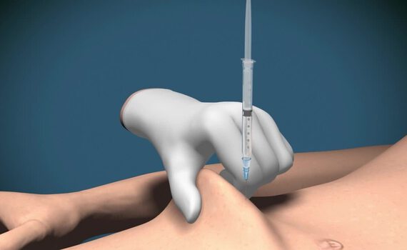 Subcutaneous injection animation demonstration - Alexander Street, a ...