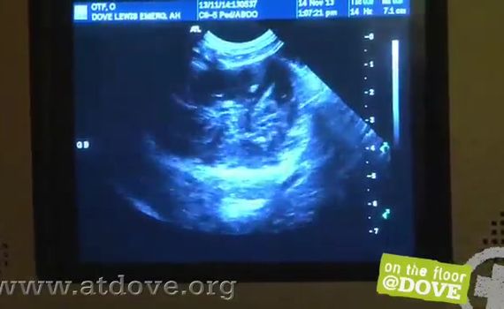 Biliary Mucocele on Ultrasound - Alexander Street, a ProQuest Company