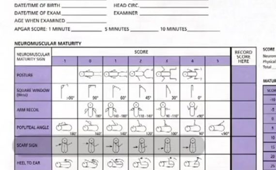 Gestational Age and Newborn Reflexes: Assessment Of Neuromuscular ...