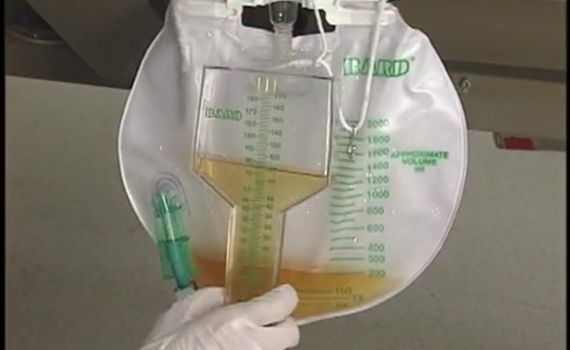 Urinary Collection From A Catheterized Patient - Alexander Street, a ...