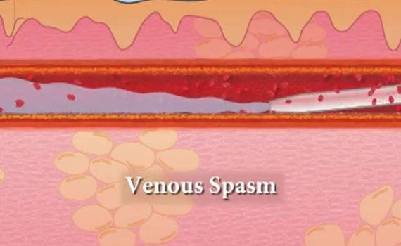 Recognizing and Treating Complications: Venous Spasm - Alexander Street ...