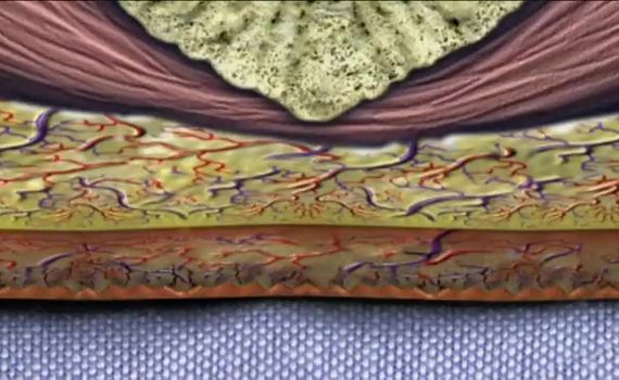 Understanding Skin Breakdown: Pressure - Alexander Street, a ProQuest ...