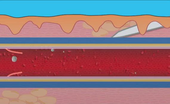 No Blood Flow or Incomplete Blood Collection - Alexander Street, a ...